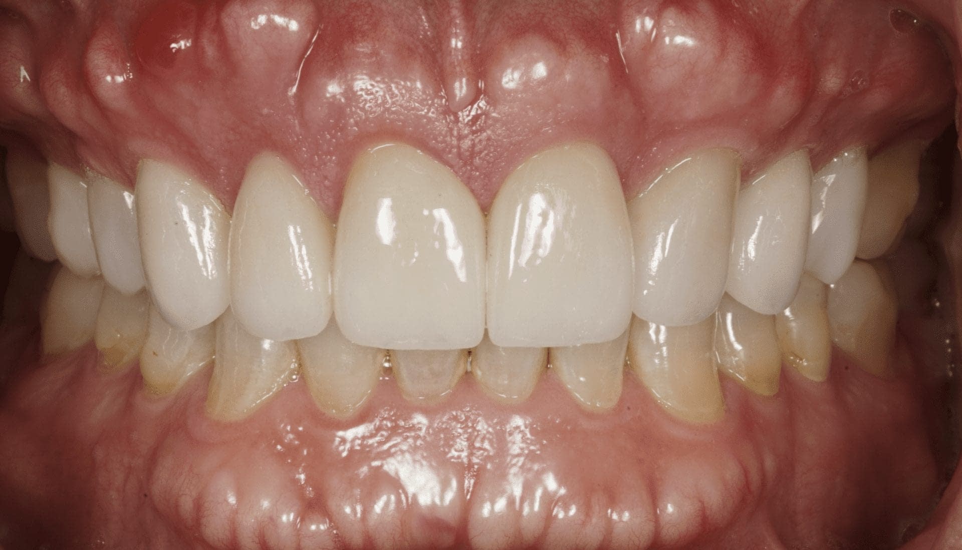 Periodontal Therapy Las Vegas | Periodontal Treatments | JB White DDS