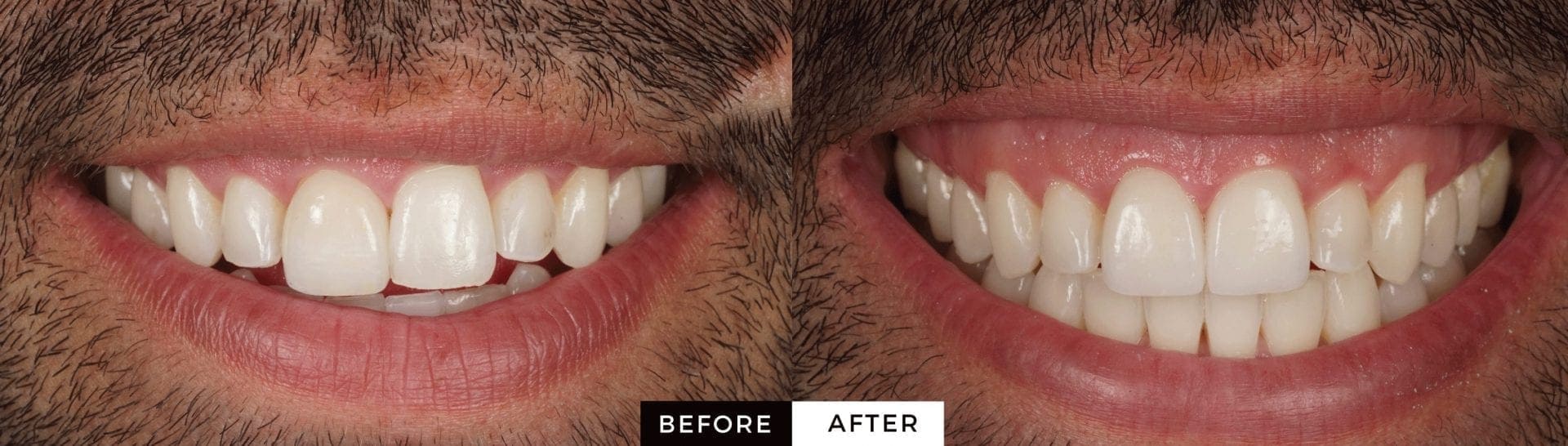 Veneers Las Vegas | Porcelain Veneers | JB White DDS Veneers Las Vegas | Porcelain Veneers | JB White DDS